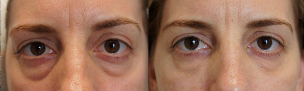 PRP for the Under-Eye Area: Procedure Review – Testosterone Center | Keller